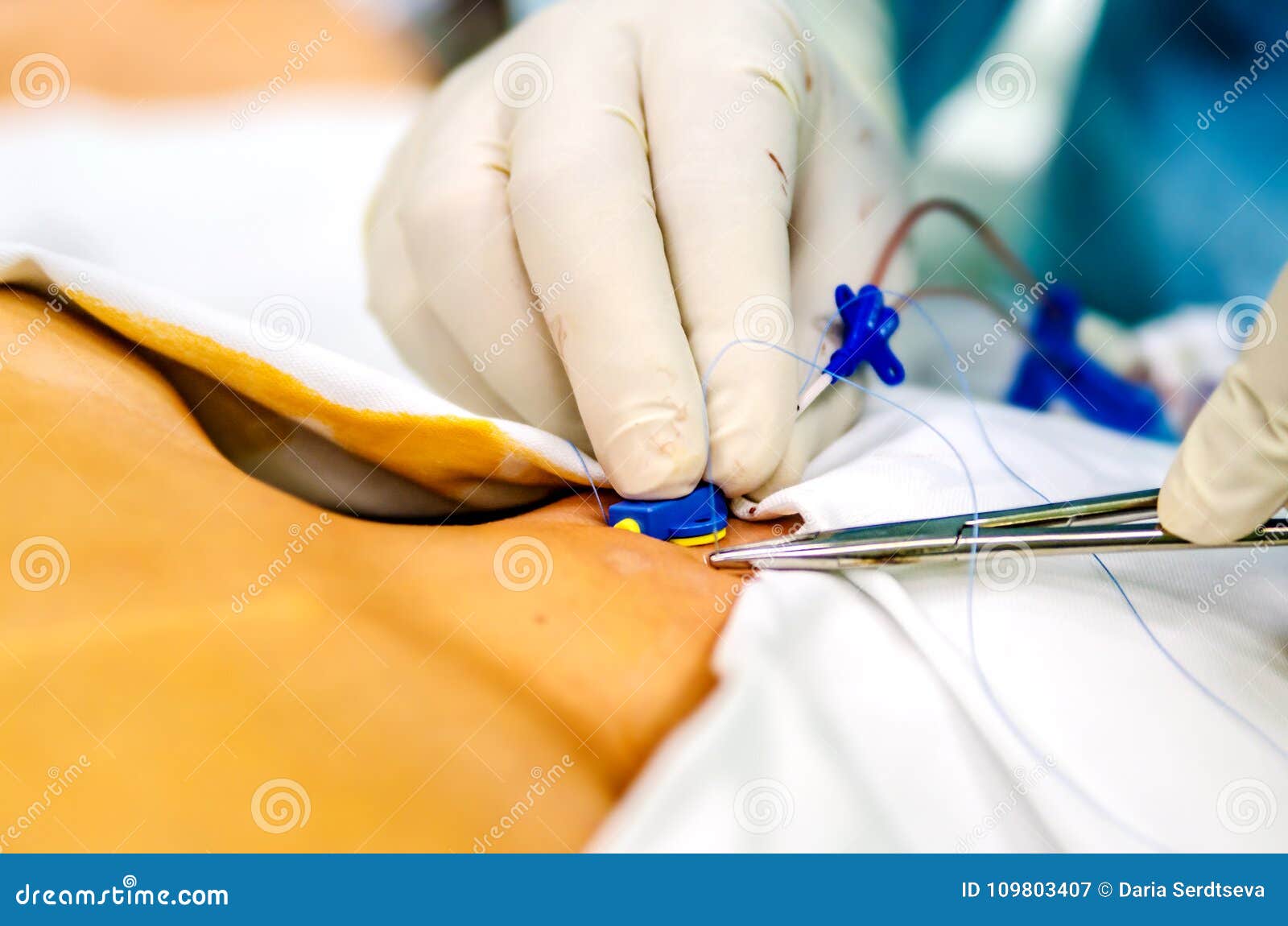 The Process of Fixing the Central Catheter by Sewing with Medical ...