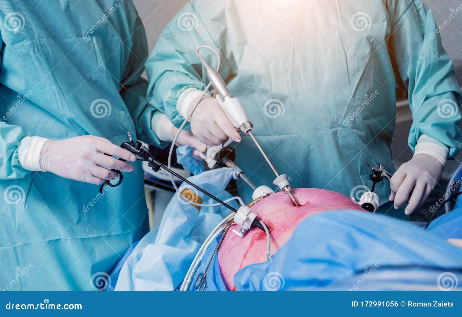 Process of Gynecological Surgery Operation Using Laparoscopic Equipment ...
