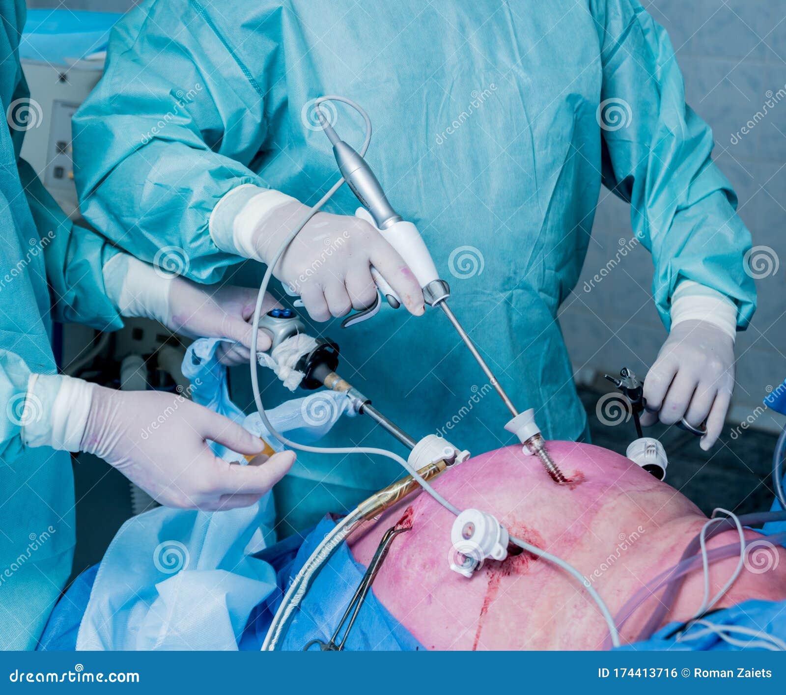 Process of Gynecological Surgery Operation Using Laparoscopic Equipment ...