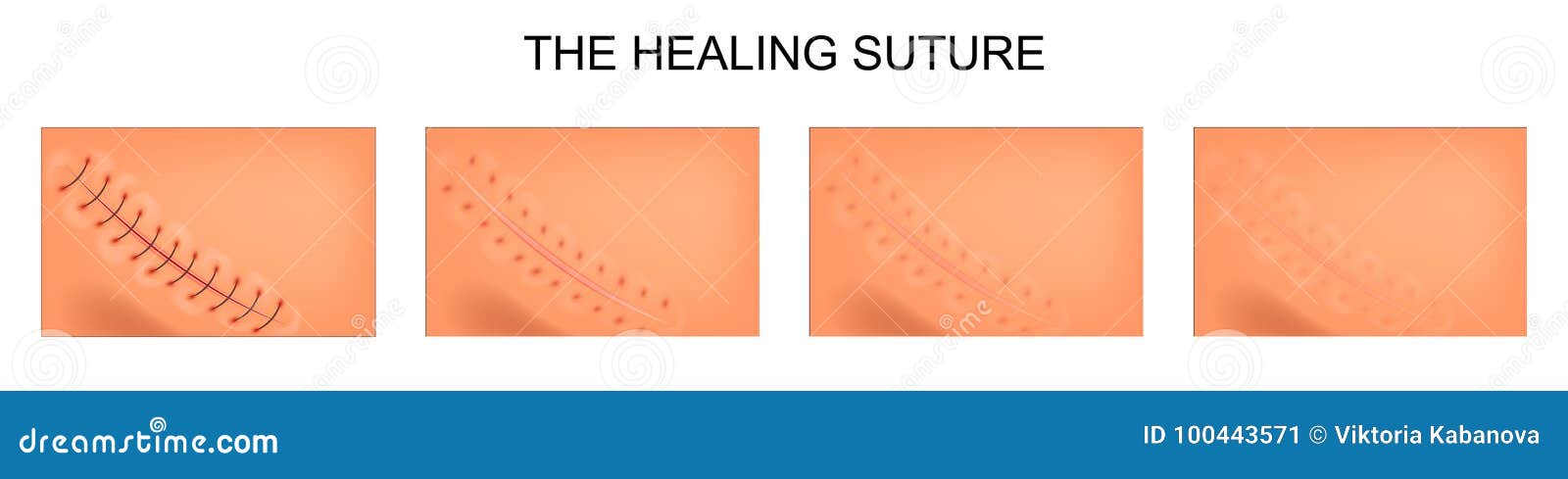 The Process of Healing of Postoperative Suture Stock Vector ...