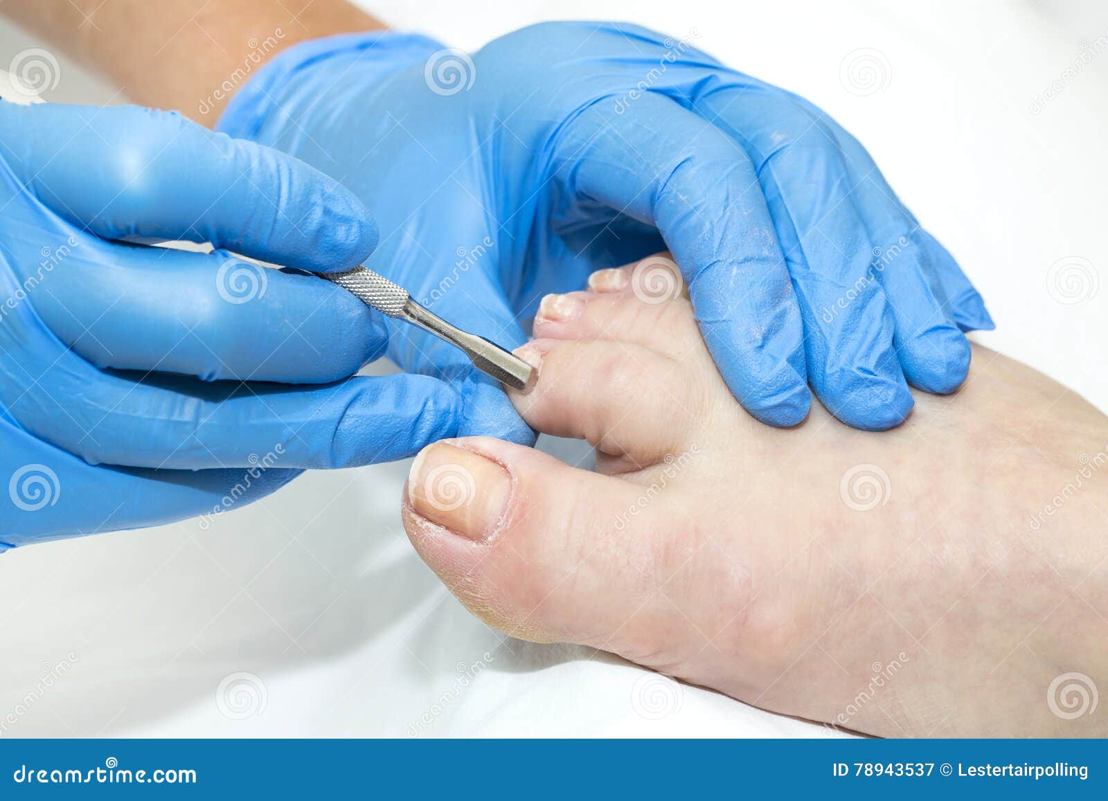 Process of pedicure stock image. Image of body, ailments - 78943537
