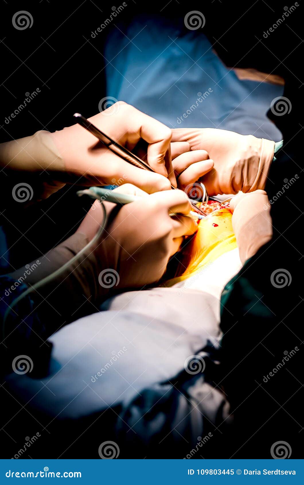 The Process of Performing a Cut of the Thorax. Stock Image - Image of ...