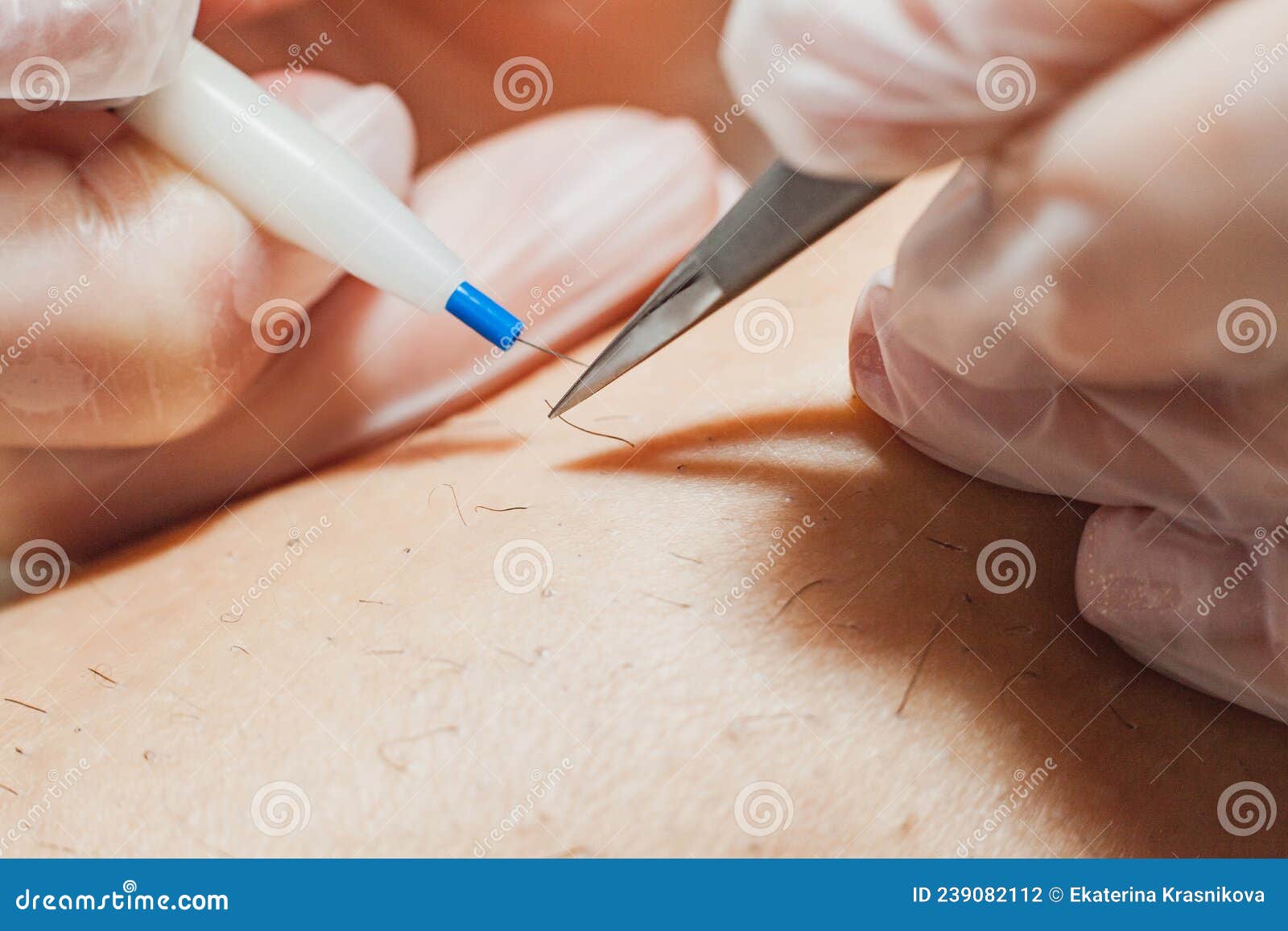 The Process of Permanent Hair Removal, Removing Unwanted Hair Using an ...
