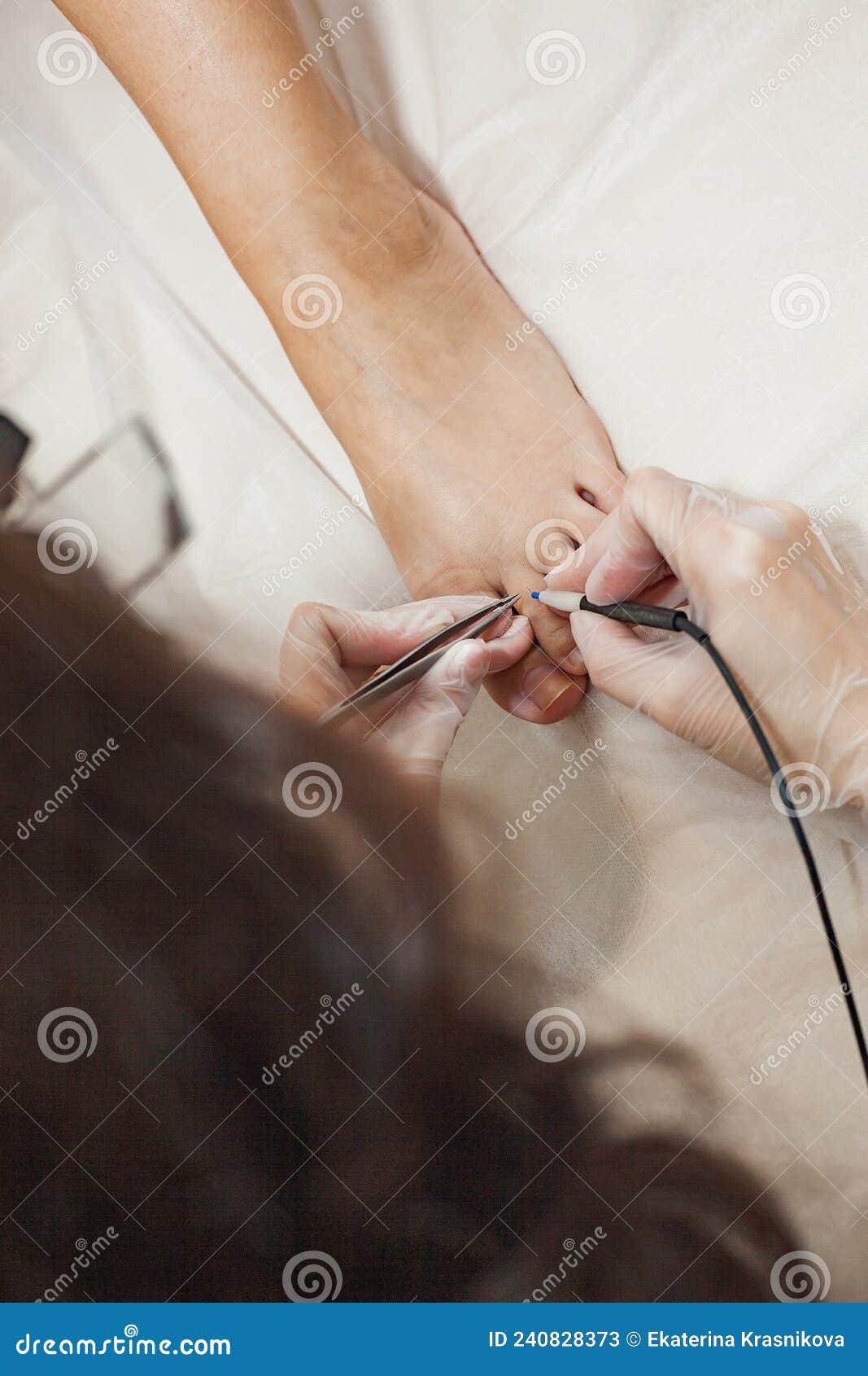 The Process of Permanent Removal of Unwanted Hair on the Toes Using an ...