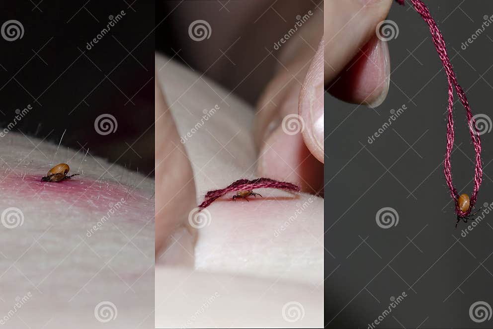 Tick with Its Head Sticking in Human Skin Stock Photo - Image of ...