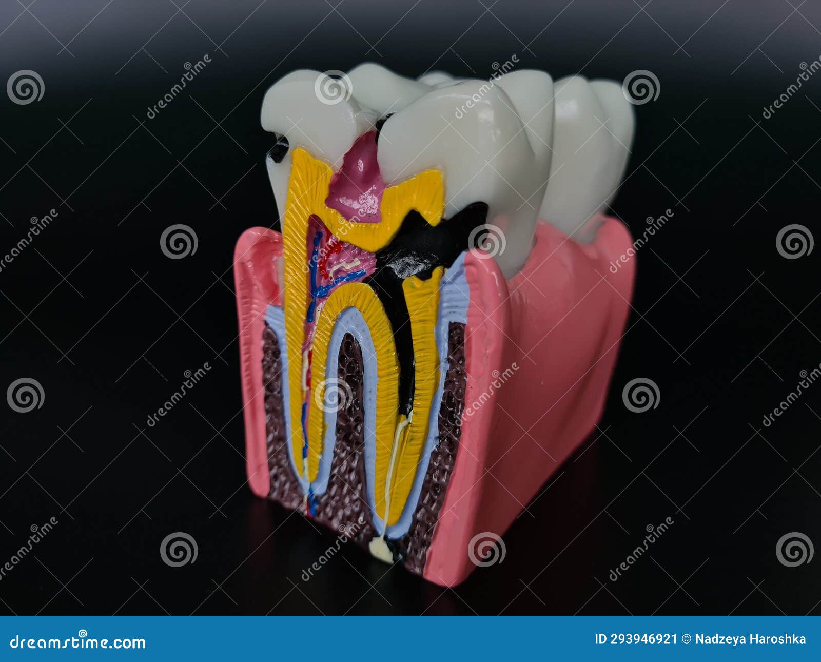 Process of Root Canal Infection and Tooth with Caries Stock Image ...