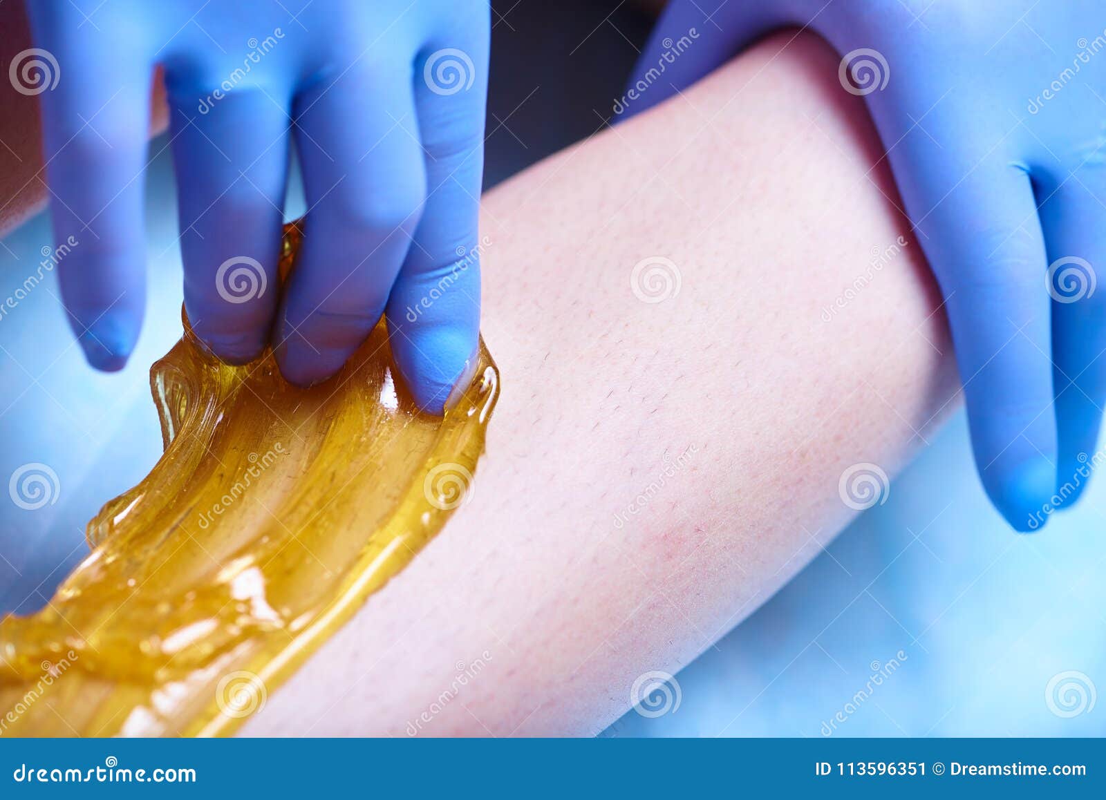 A Process of Sugaring Depilation Stock Image - Image of hygiene, hair ...
