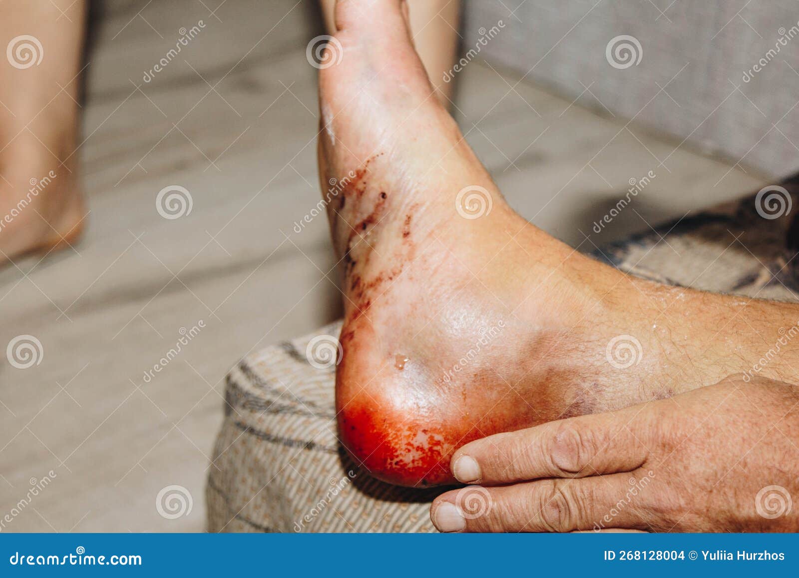 The Process of Treating a Leg Injury at Home. Scar after Surgery. Bone ...