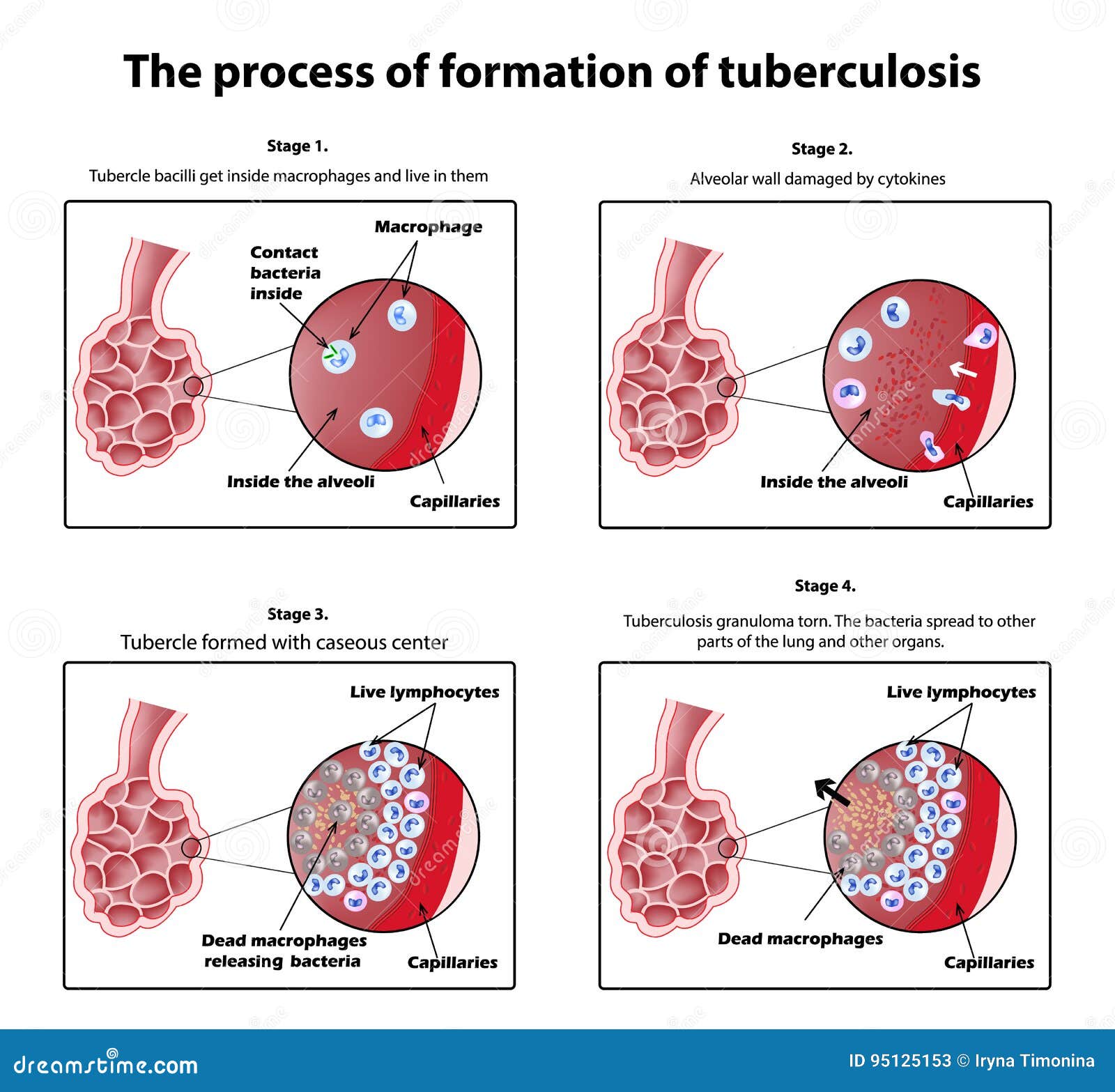 The Process of Tuberculosis Formation. Infographics. Vector ...