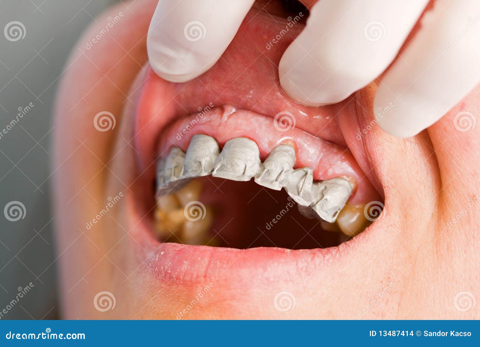 Proef Van Een Vast Gedeeltelijk Gebit Stock Foto - Image of ...