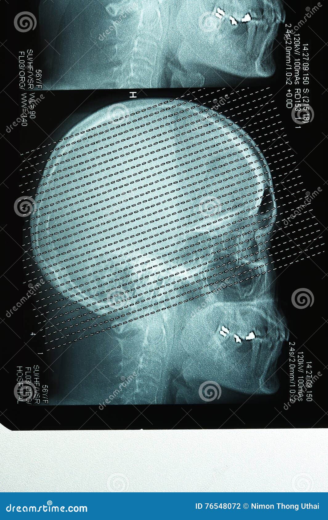 Profile View with a Human Skull X Ray Stock Photo - Image of ...