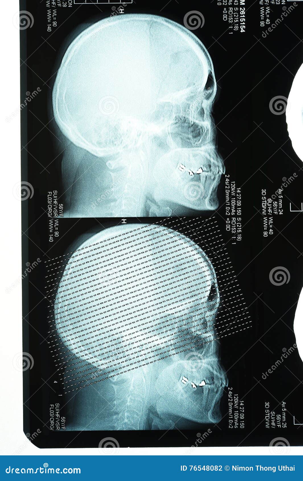 Profile View with a Human Skull X Ray Stock Photo - Image of structure ...