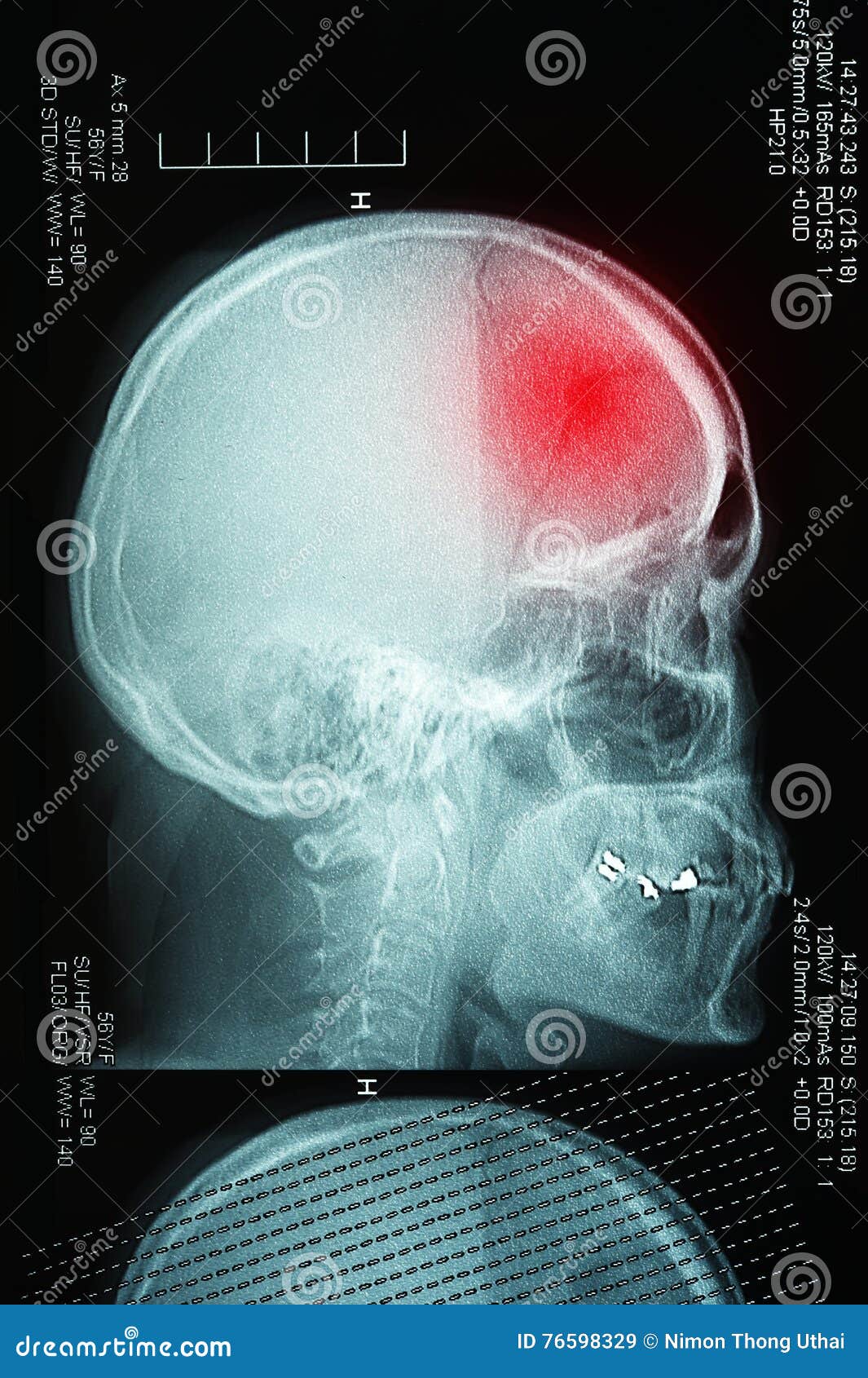 Profile View with a Human Skull X Ray Stock Image - Image of medical ...