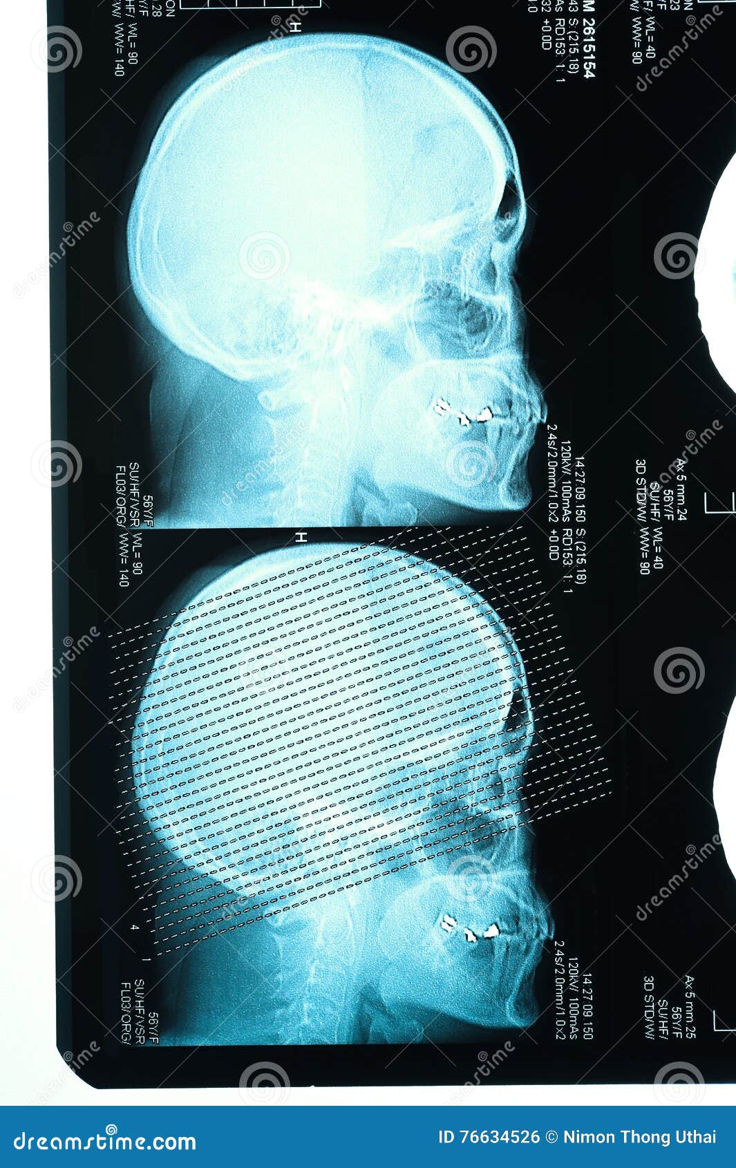 Profile View with a Human Skull X Ray Stock Photo - Image of brain ...