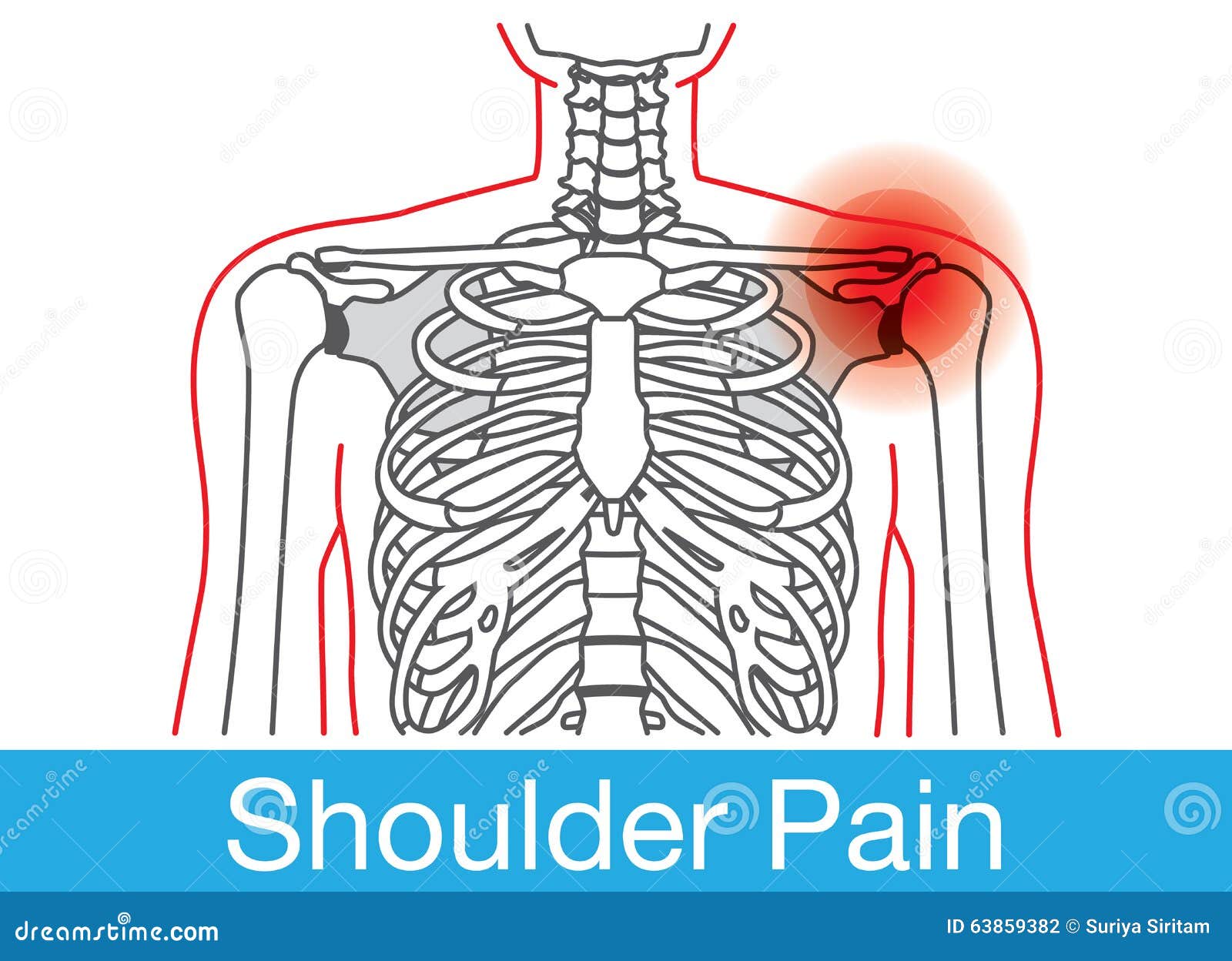 Profilo Di Dolore Della Spalla Illustrazione Vettoriale - Illustrazione ...