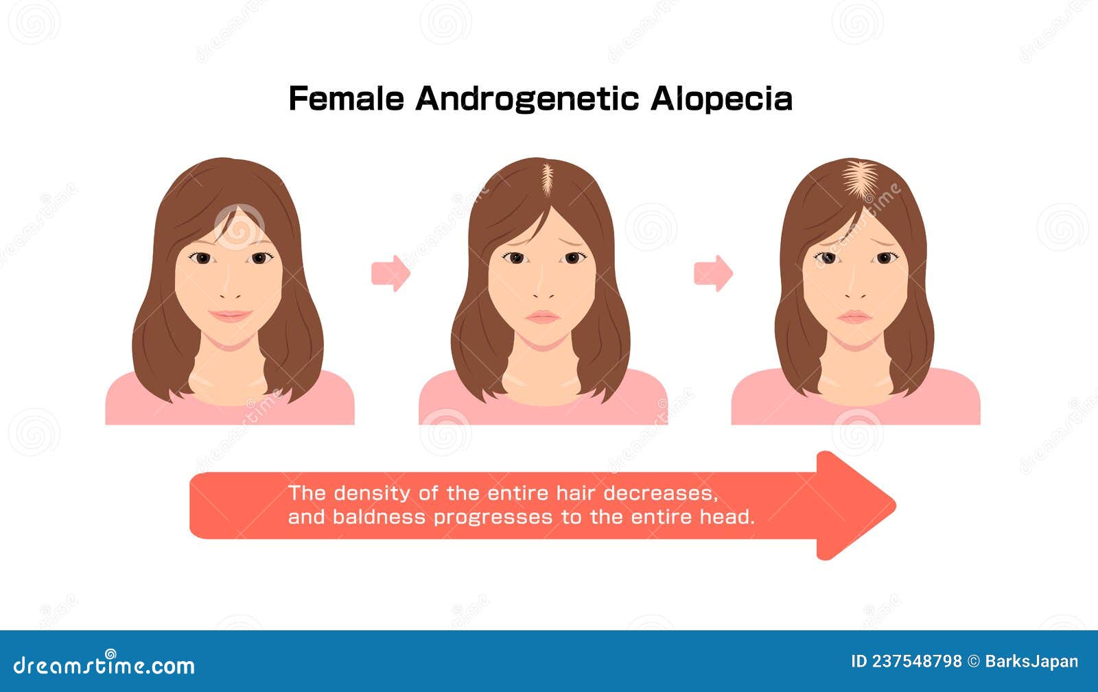 Progress of Female Androgenetic Alopecia. Vector Illustration Stock ...