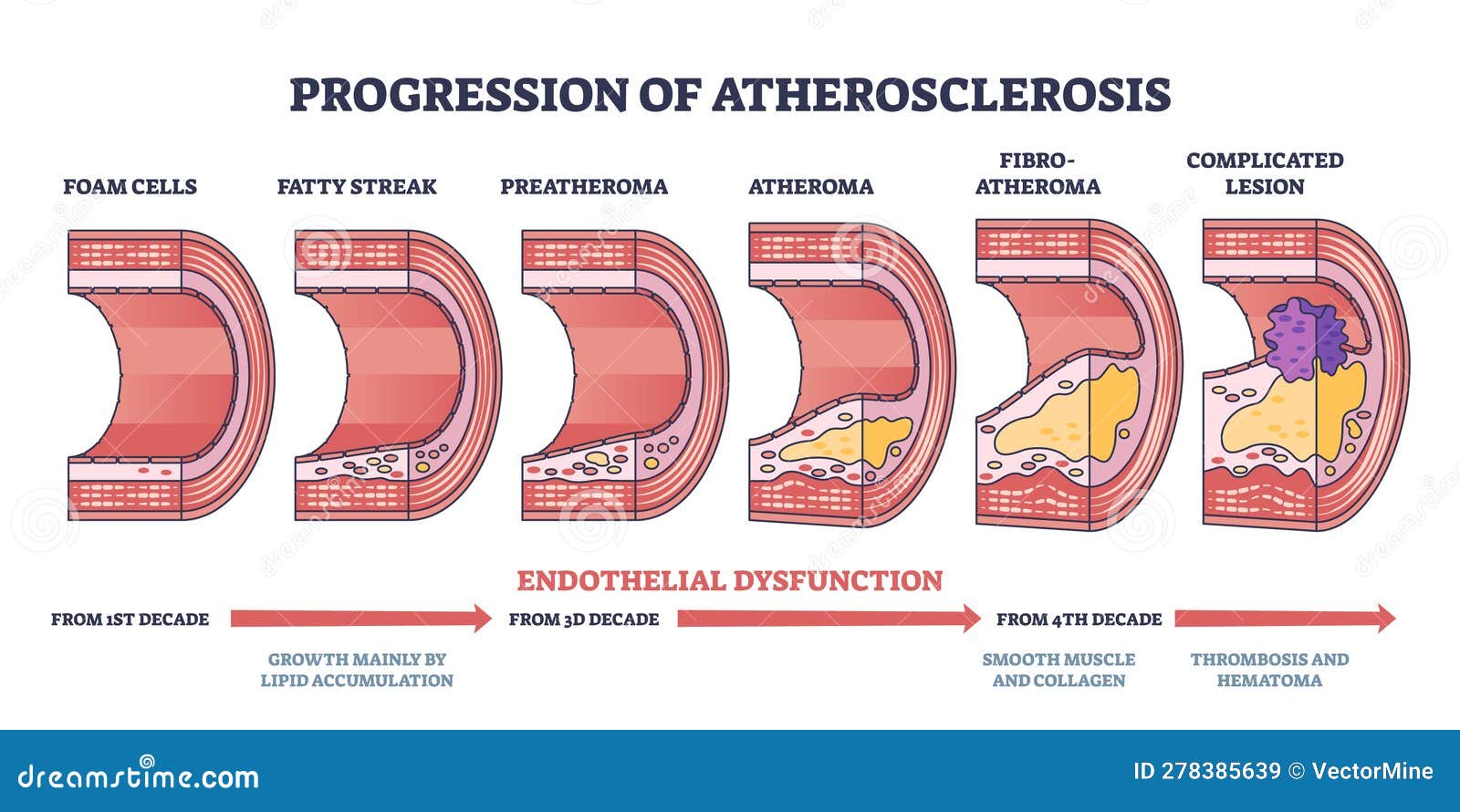 Progression of Atherosclerosis and Thrombosis Formation Outline Diagram ... Progression of Atherosclerosis and Thrombosis Formation Outline Diagram ...