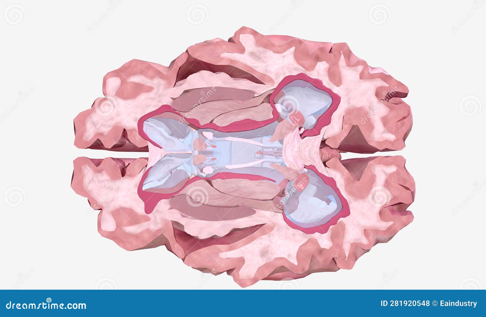 Progression of Multiple Sclerosis Transverse View Stock Illustration ...