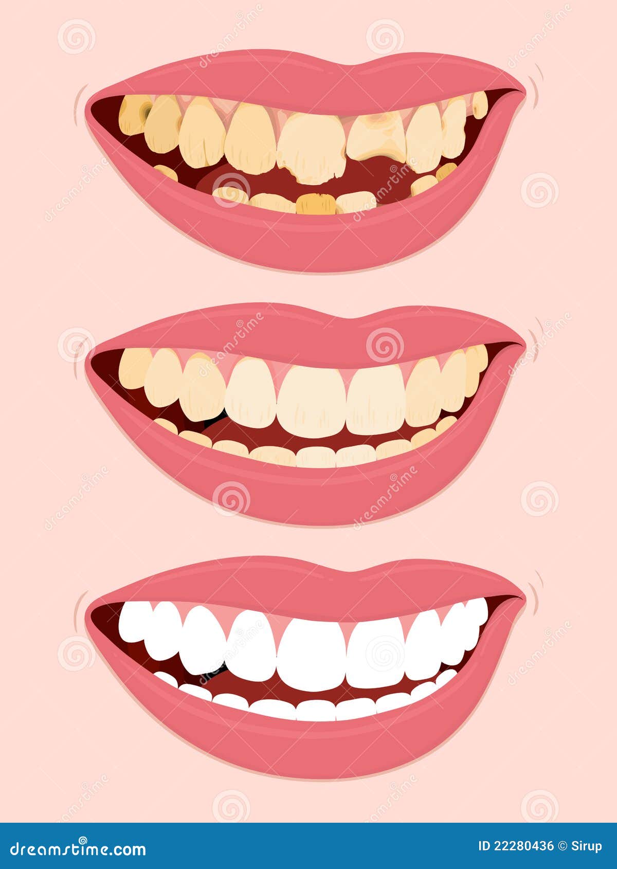 Progressive Stages of Tooth Decay Caries Stock Vector - Illustration of ...