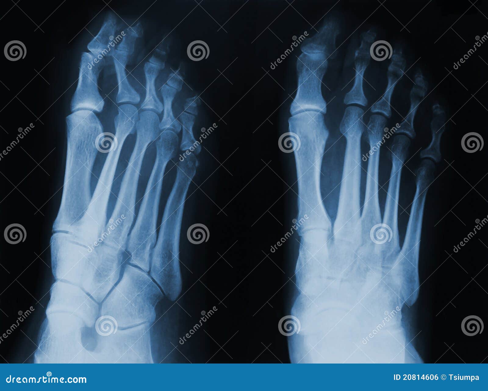 Promień x zdjęcie stock. Obraz złożonej z nadgarstek - 20814606
