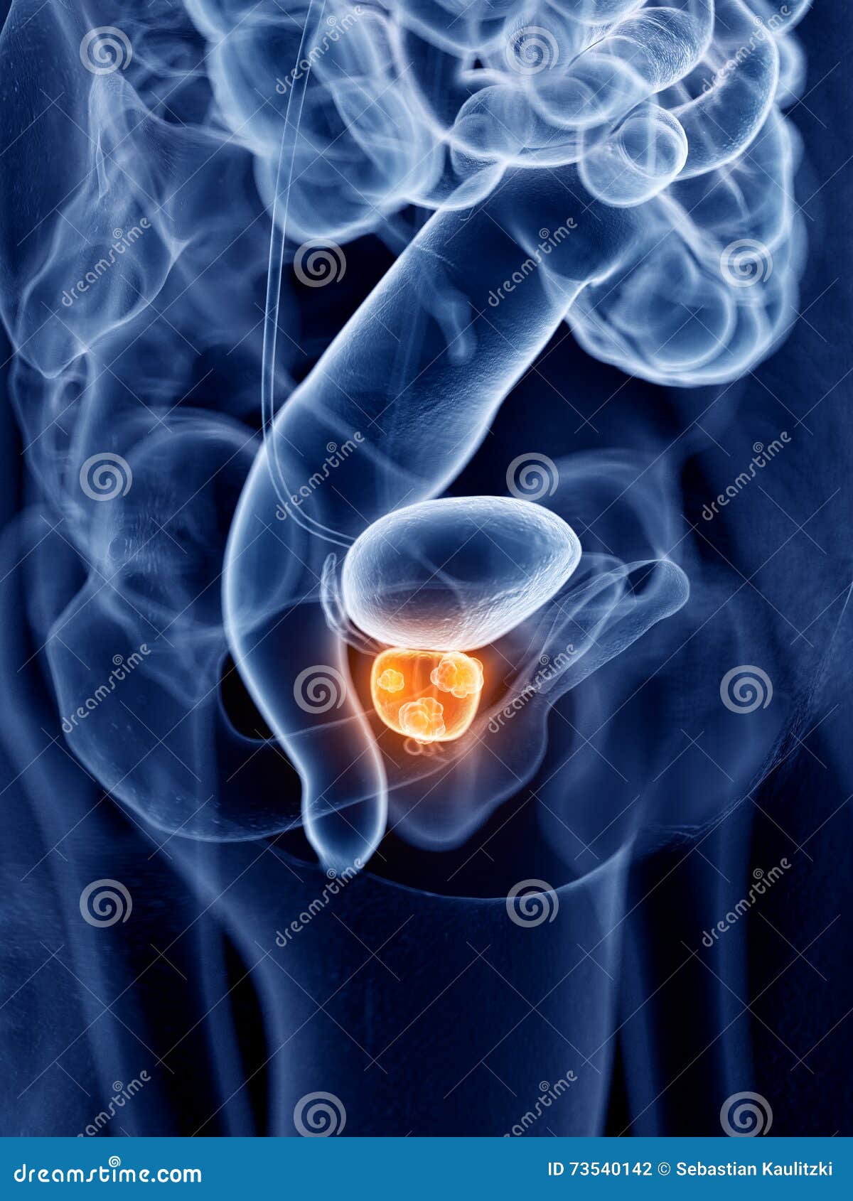 PROSTATACANCER stock illustrationer. Illustration av inälvor - 73540142