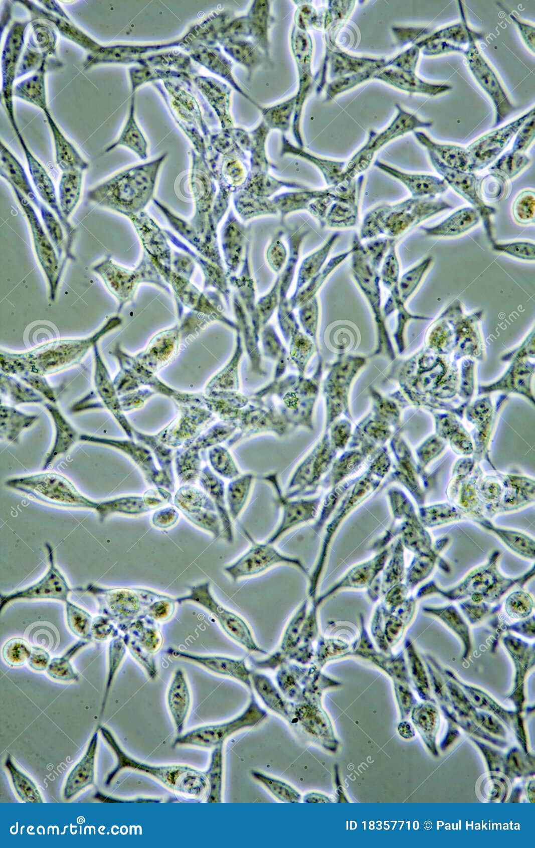 Cancer Cells Under Microscope Royalty-Free Stock Photography ...