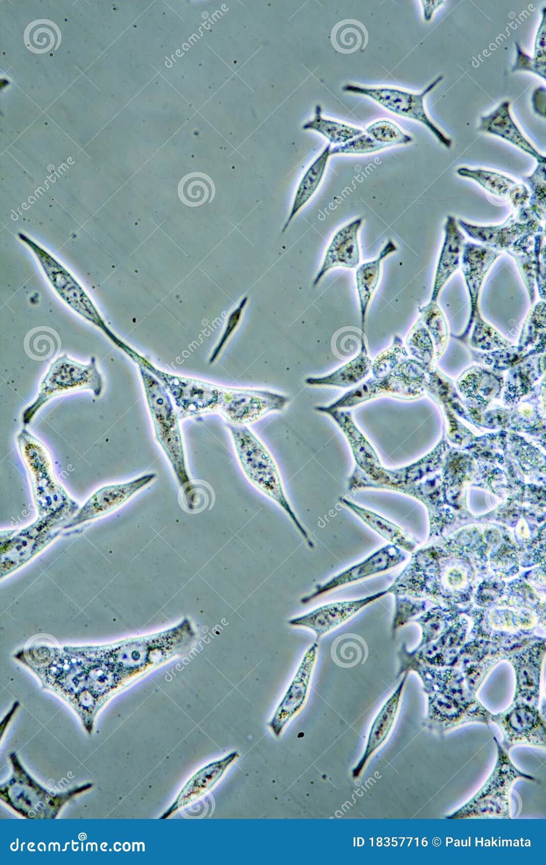 Prostate Cancer cells stock photo. Image of cells, medicine - 18357716