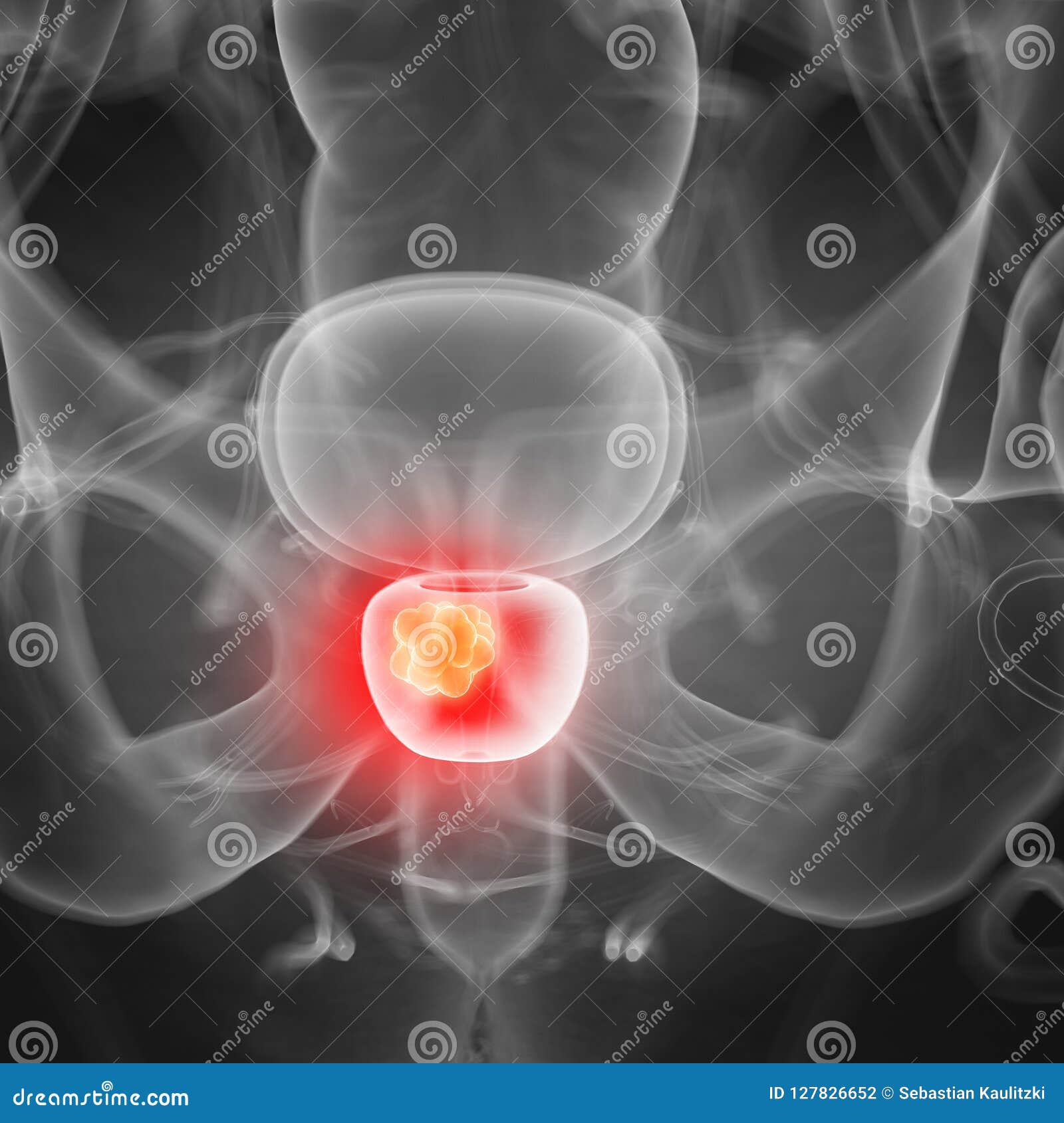Prostate cancer stock illustration. Illustration of cancer - 127826652