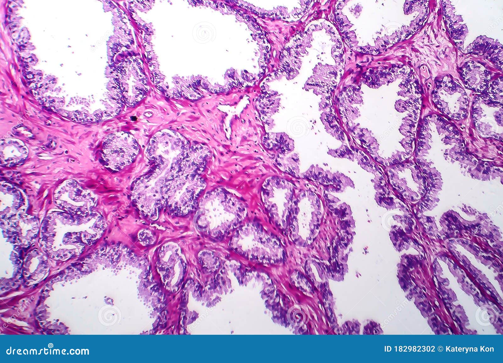 Prostate Cancer, Light Micrograph Stock Photo - Image of neoplasm ...