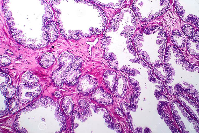Prostate Cancer, Light Micrograph Stock Photo - Image of neoplasm ...