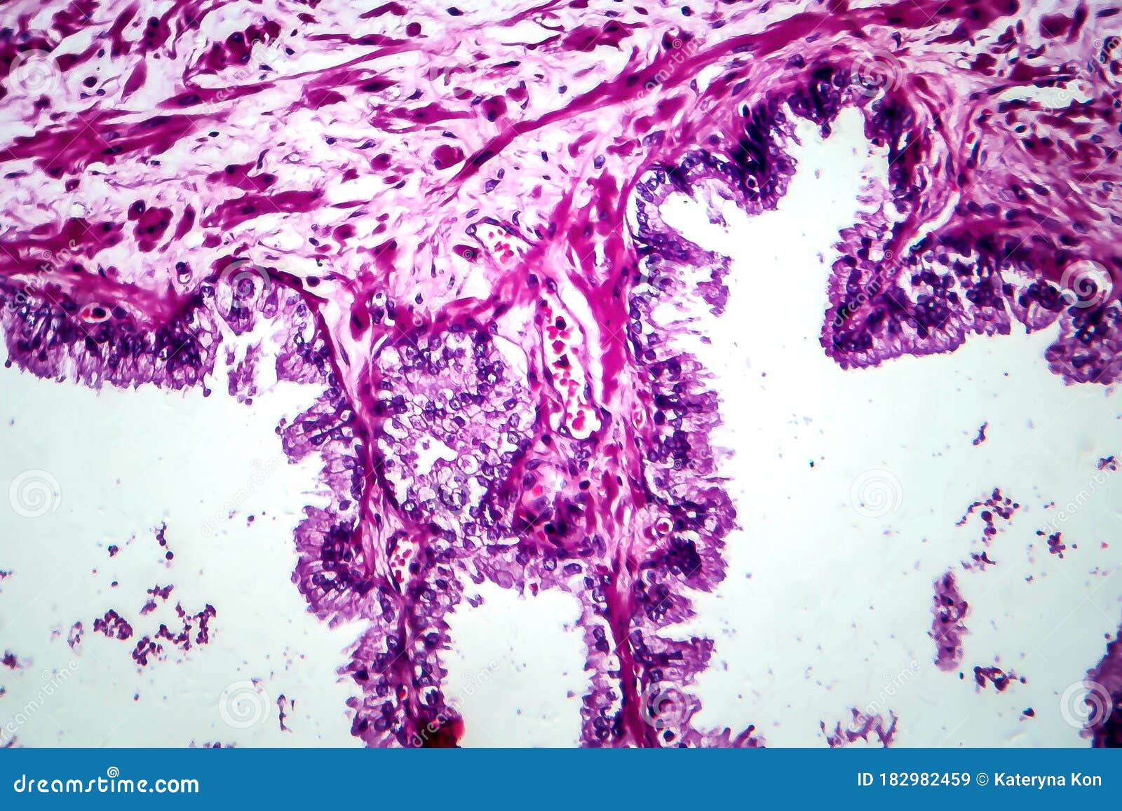Prostate Cancer, Light Micrograph Stock Image - Image of morphology ...