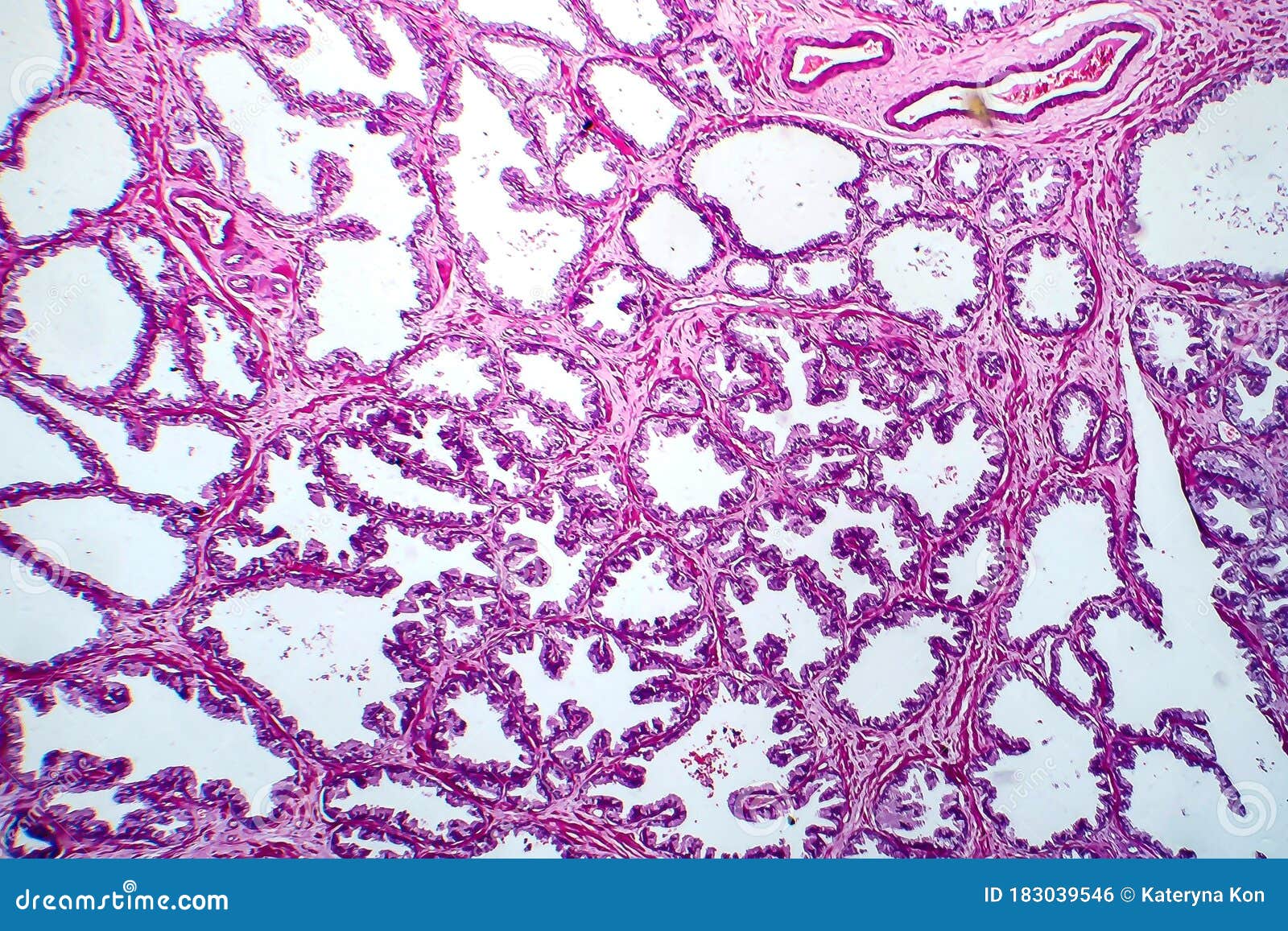 Prostate Cancer, Light Micrograph Stock Photo - Image of ...