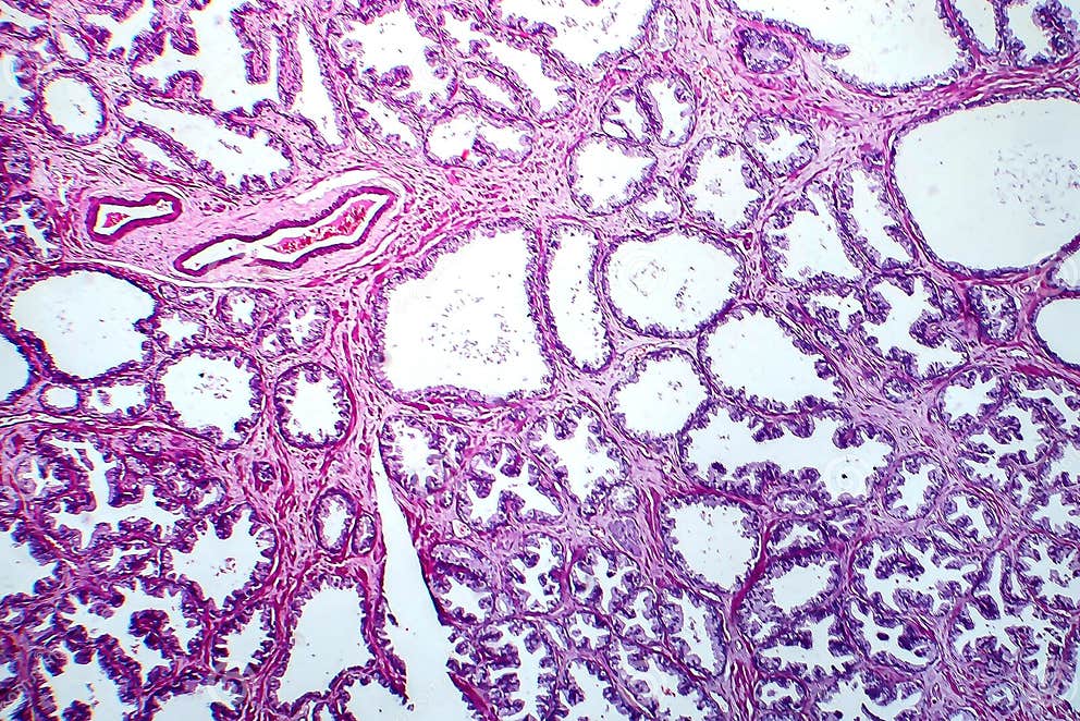 Prostate Cancer, Light Micrograph Stock Image - Image of neoplasm ...