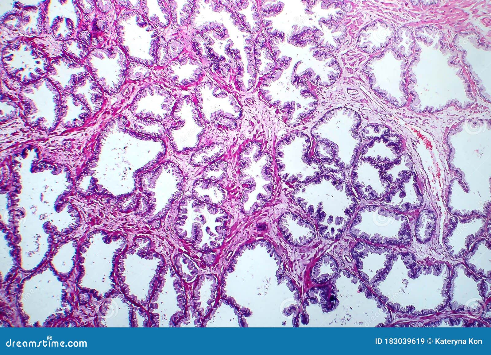 Prostate Cancer, Light Micrograph Stock Image - Image of histology ...