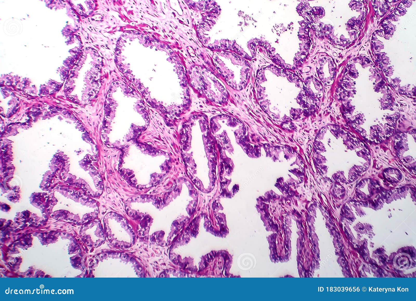 Prostate Cancer, Light Micrograph Stock Photo - Image of gland ...