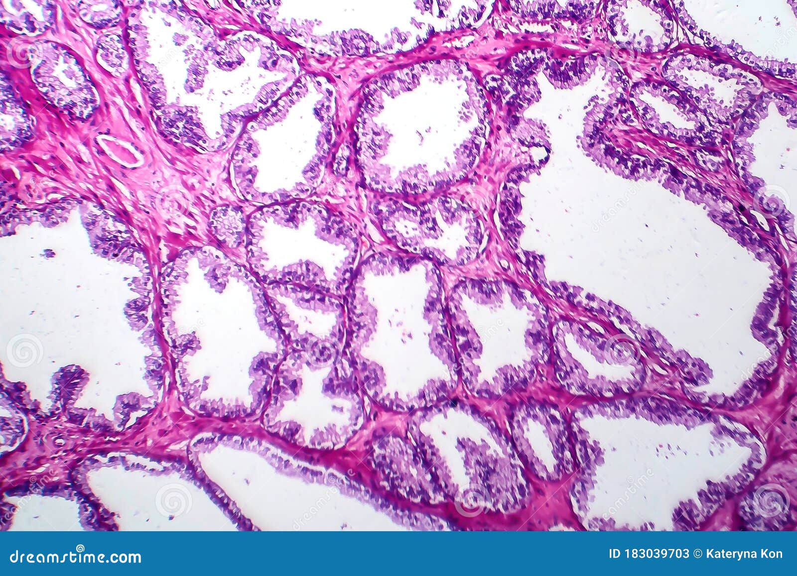 Prostate Cancer, Light Micrograph Stock Image - Image of neoplasm ...