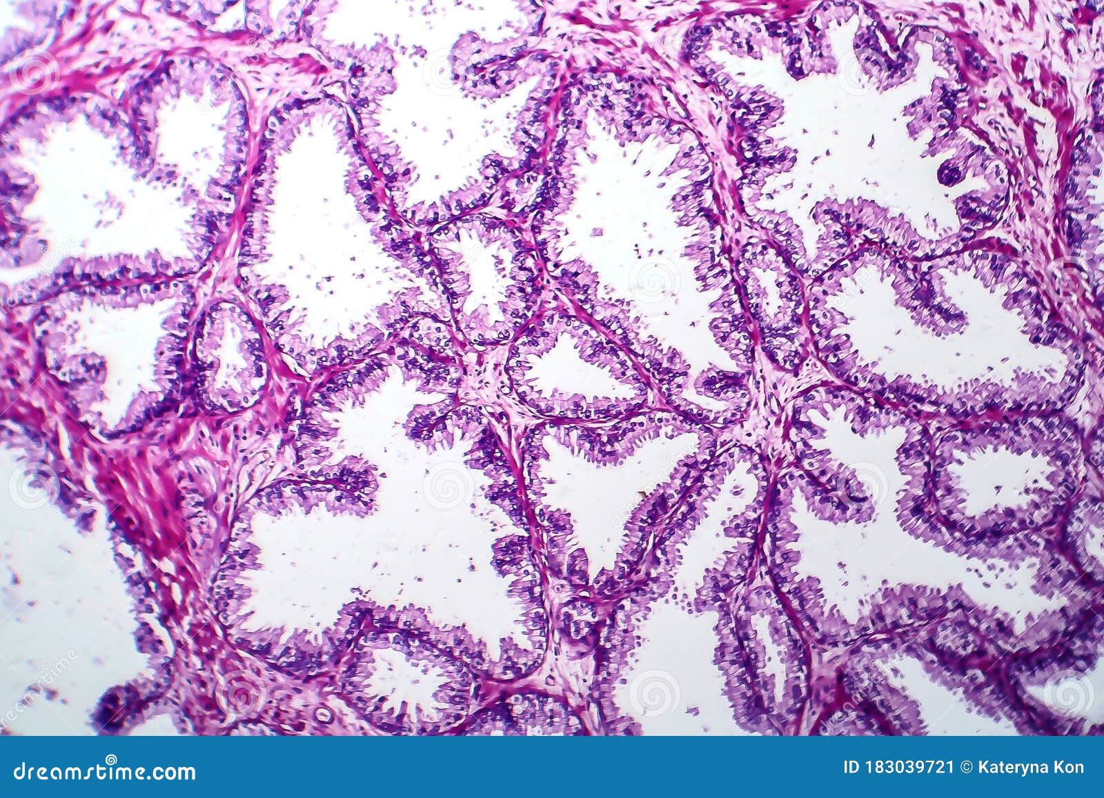 Prostate Cancer, Light Micrograph Stock Image - Image of carcinoma ...