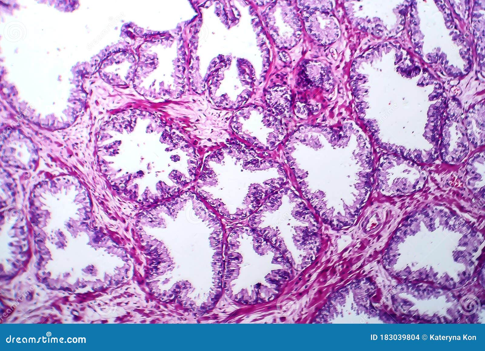Prostate Cancer, Light Micrograph Stock Photo - Image of oncology ...