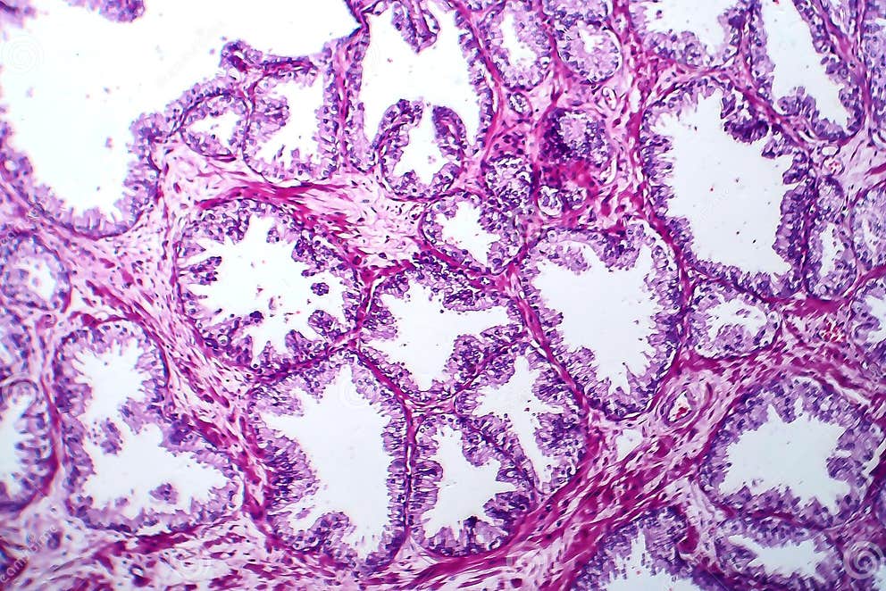 Prostate Cancer, Light Micrograph Stock Photo - Image of oncology ...