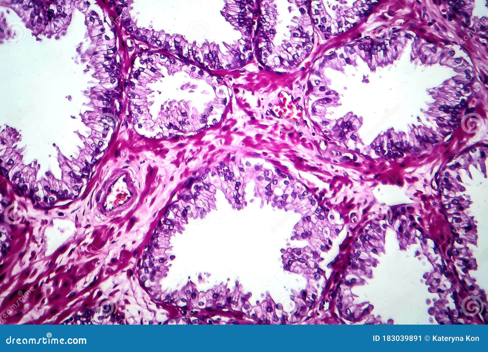 Prostate Cancer, Light Micrograph Stock Image - Image of neoplasm ...