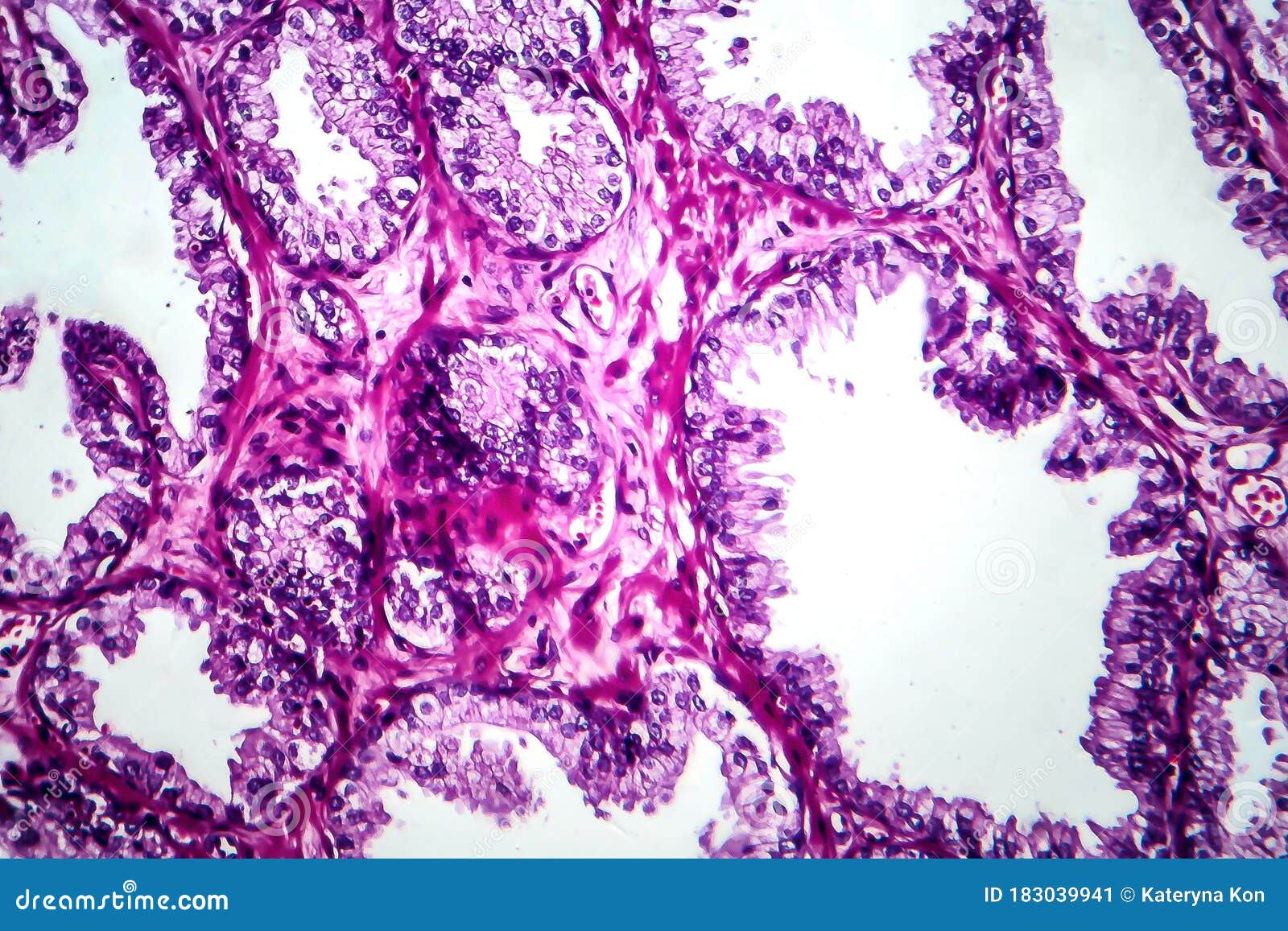 Prostate Cancer, Light Micrograph Stock Image - Image of cancer ...