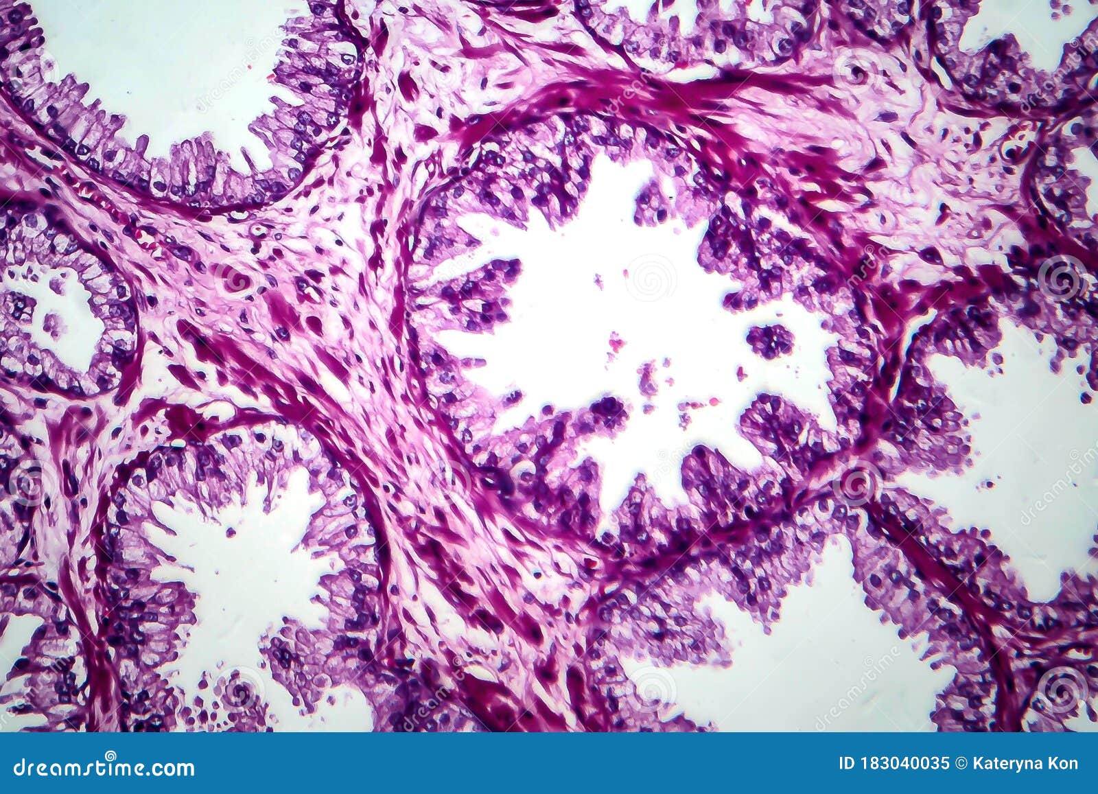 Prostate Cancer, Light Micrograph Stock Image - Image of illness ...