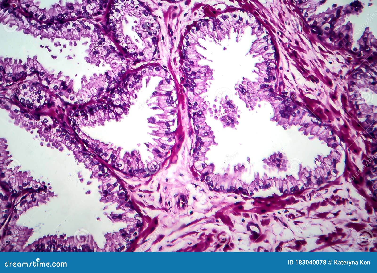 Prostate Cancer, Light Micrograph Stock Photo - Image of histopathology ...