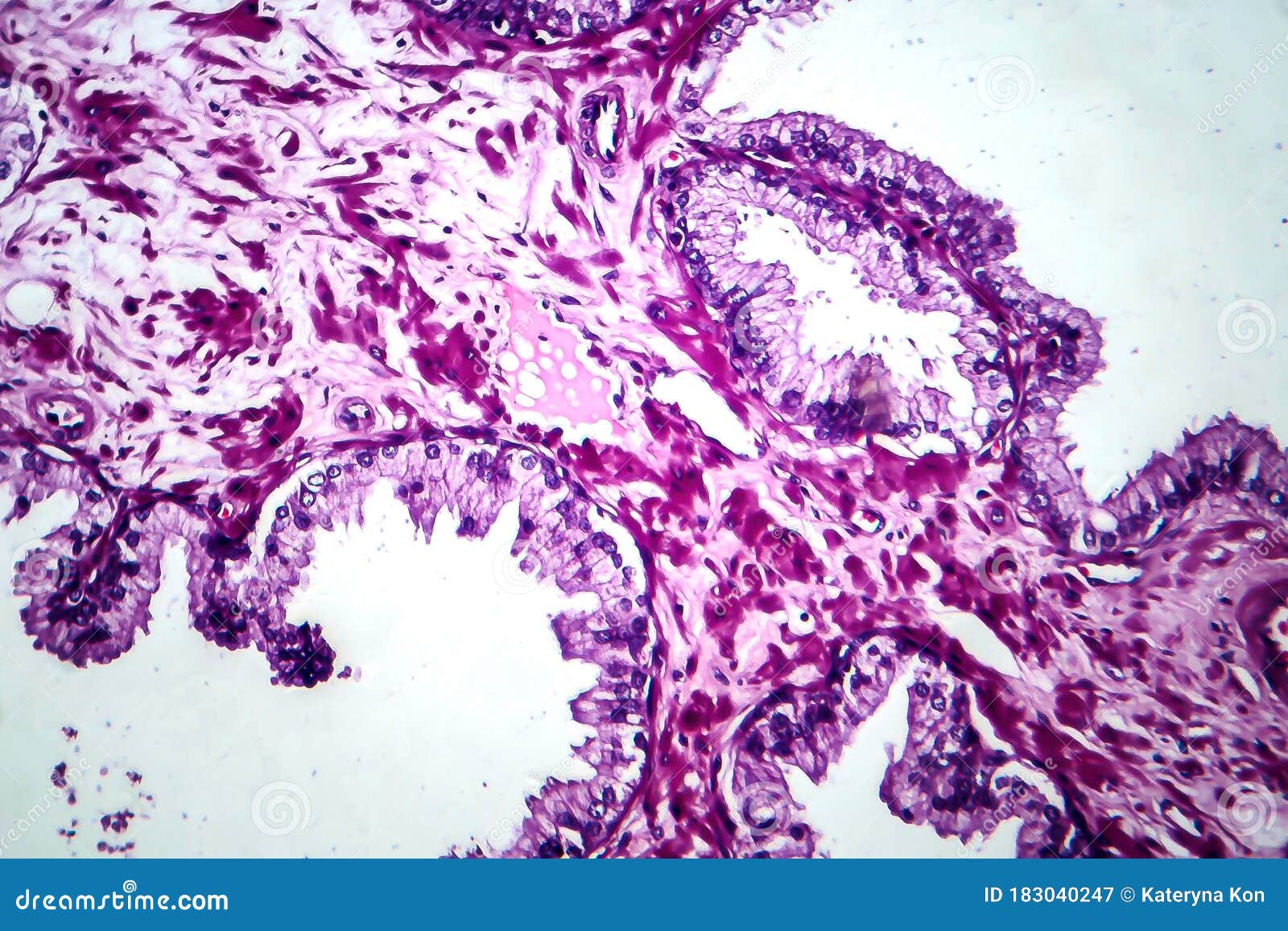 Prostate Cancer, Light Micrograph Stock Image - Image of hematoxylin ...