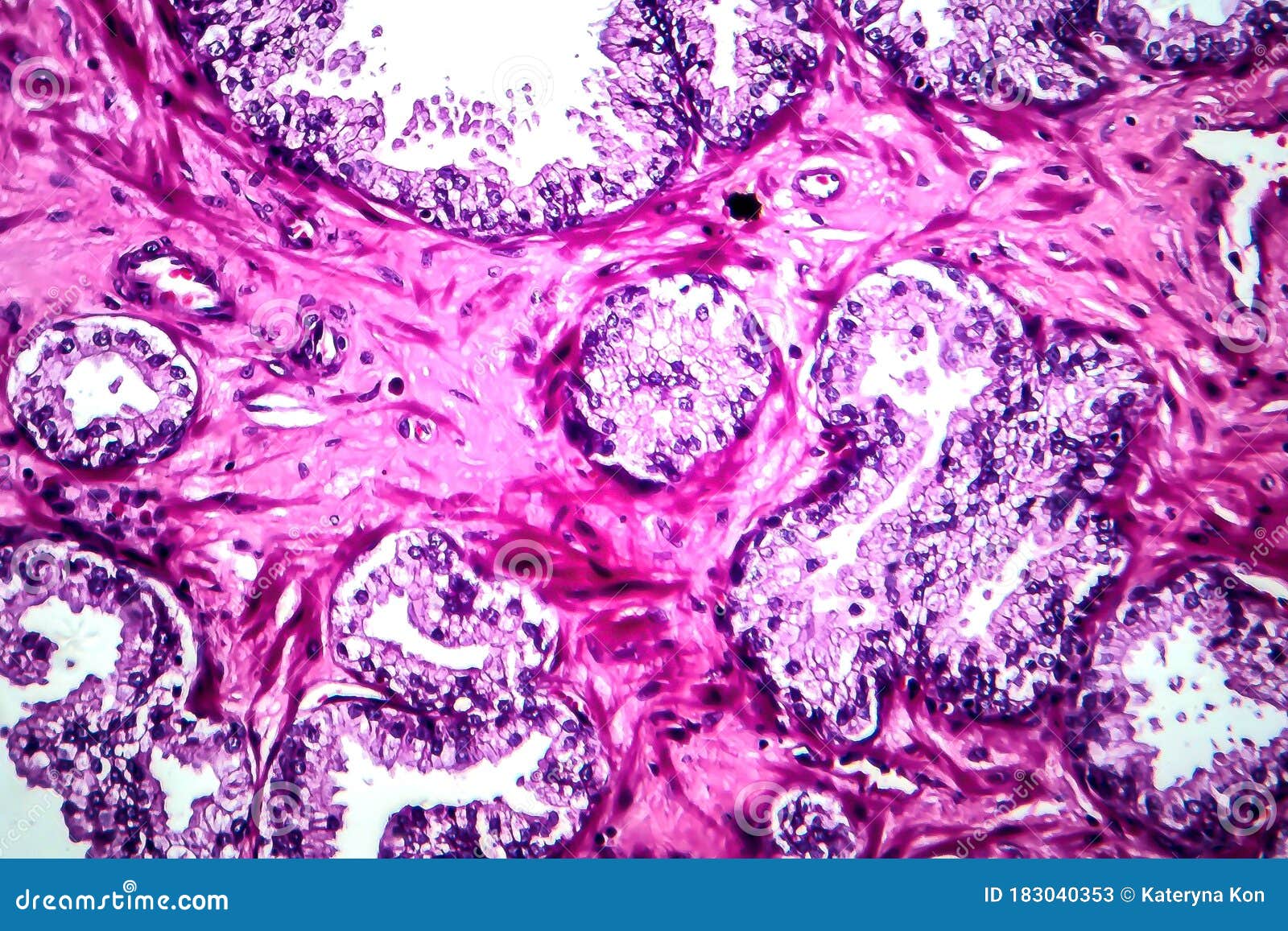 Prostate Cancer, Light Micrograph Stock Image - Image of illness ...