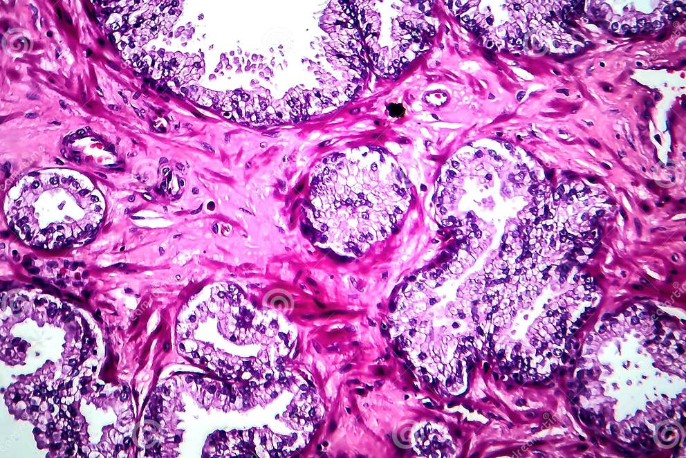 Prostate Cancer, Light Micrograph Stock Image - Image of illness ...