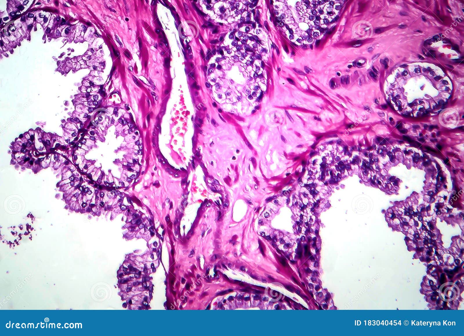 Prostate Cancer, Light Micrograph Stock Photo - Image of male, disease ...