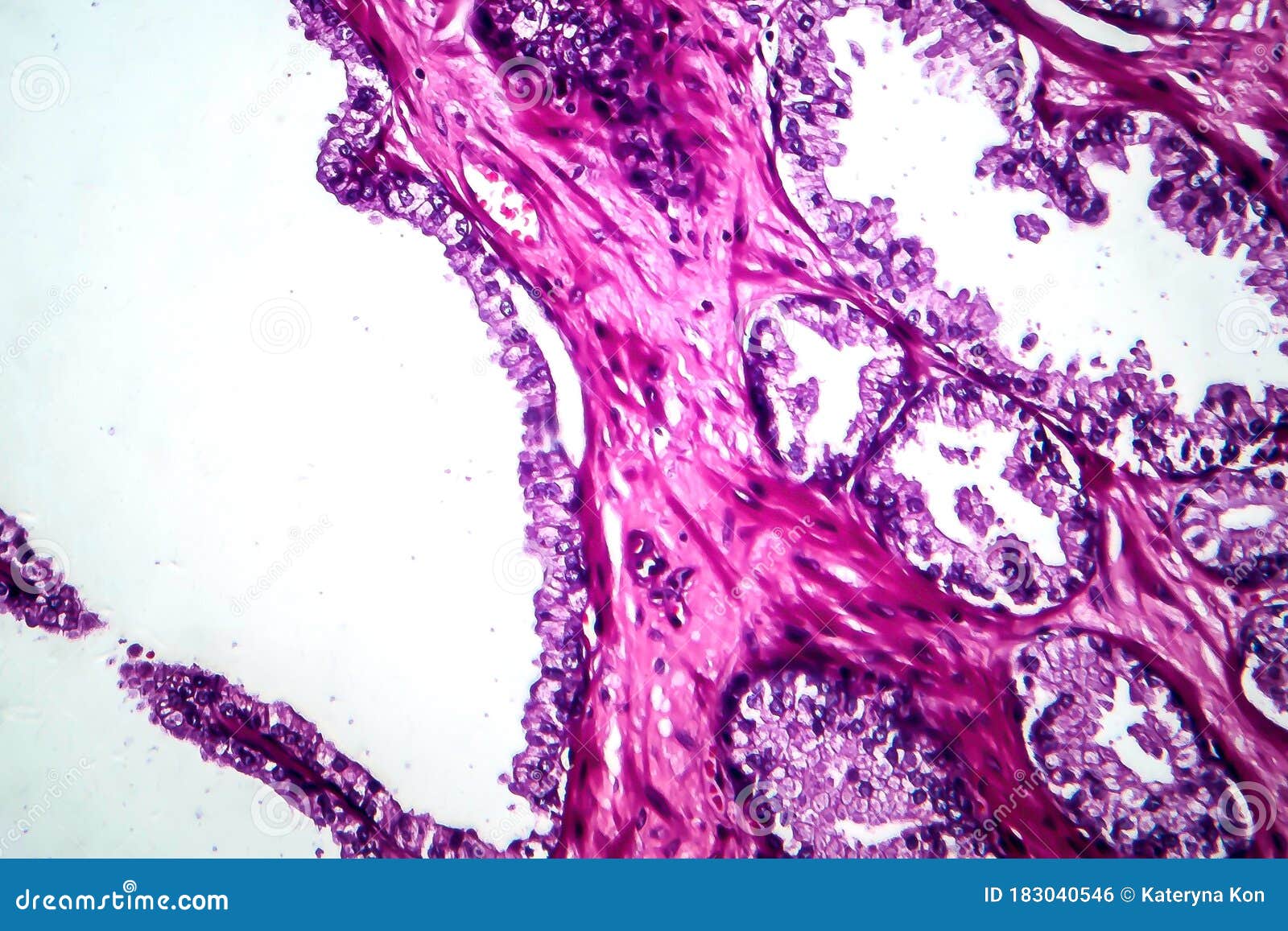 Prostate Cancer, Light Micrograph Stock Photo - Image of gland, eosin ...