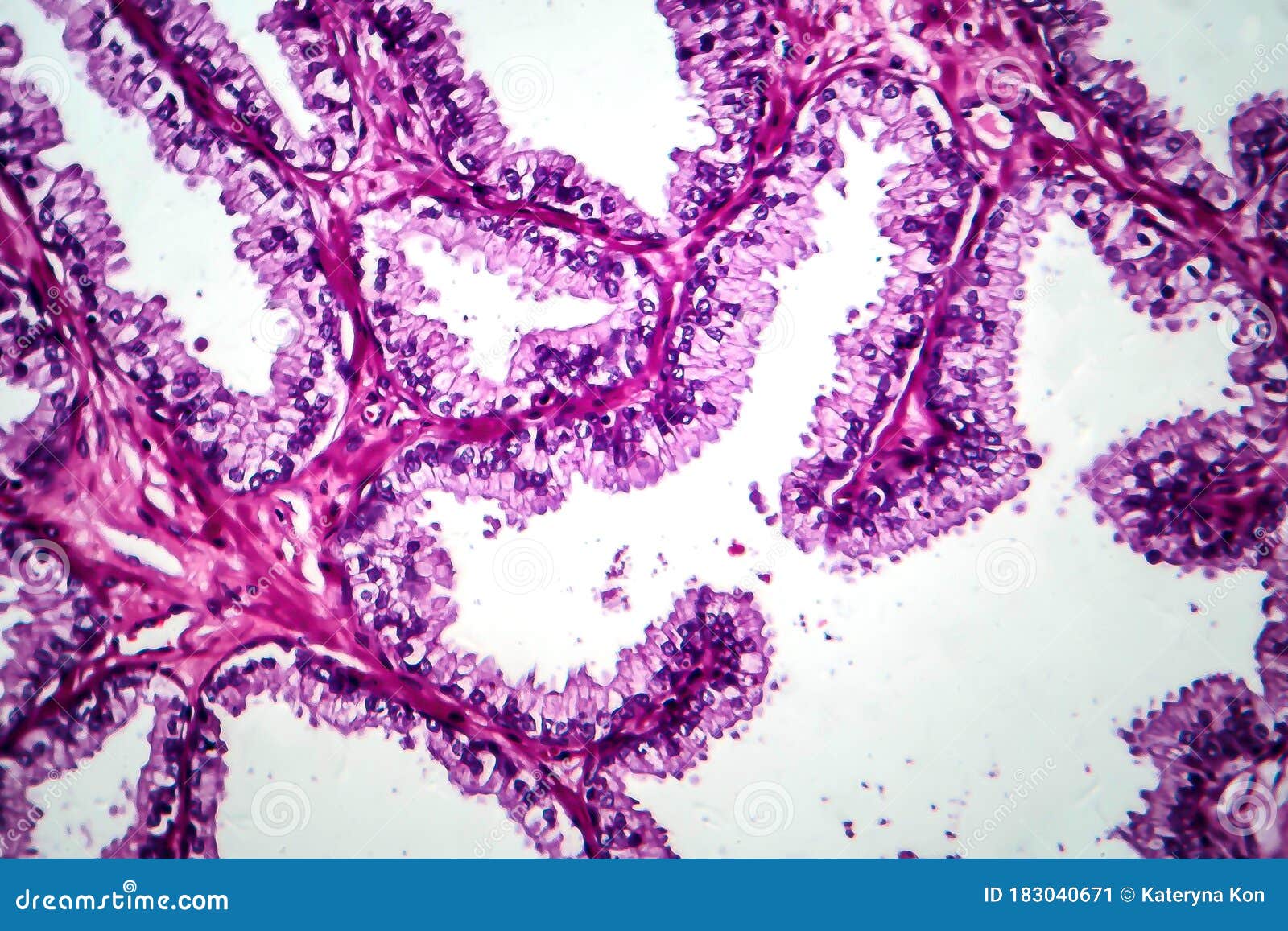 Prostate Cancer, Light Micrograph Stock Image - Image of microscopy ...