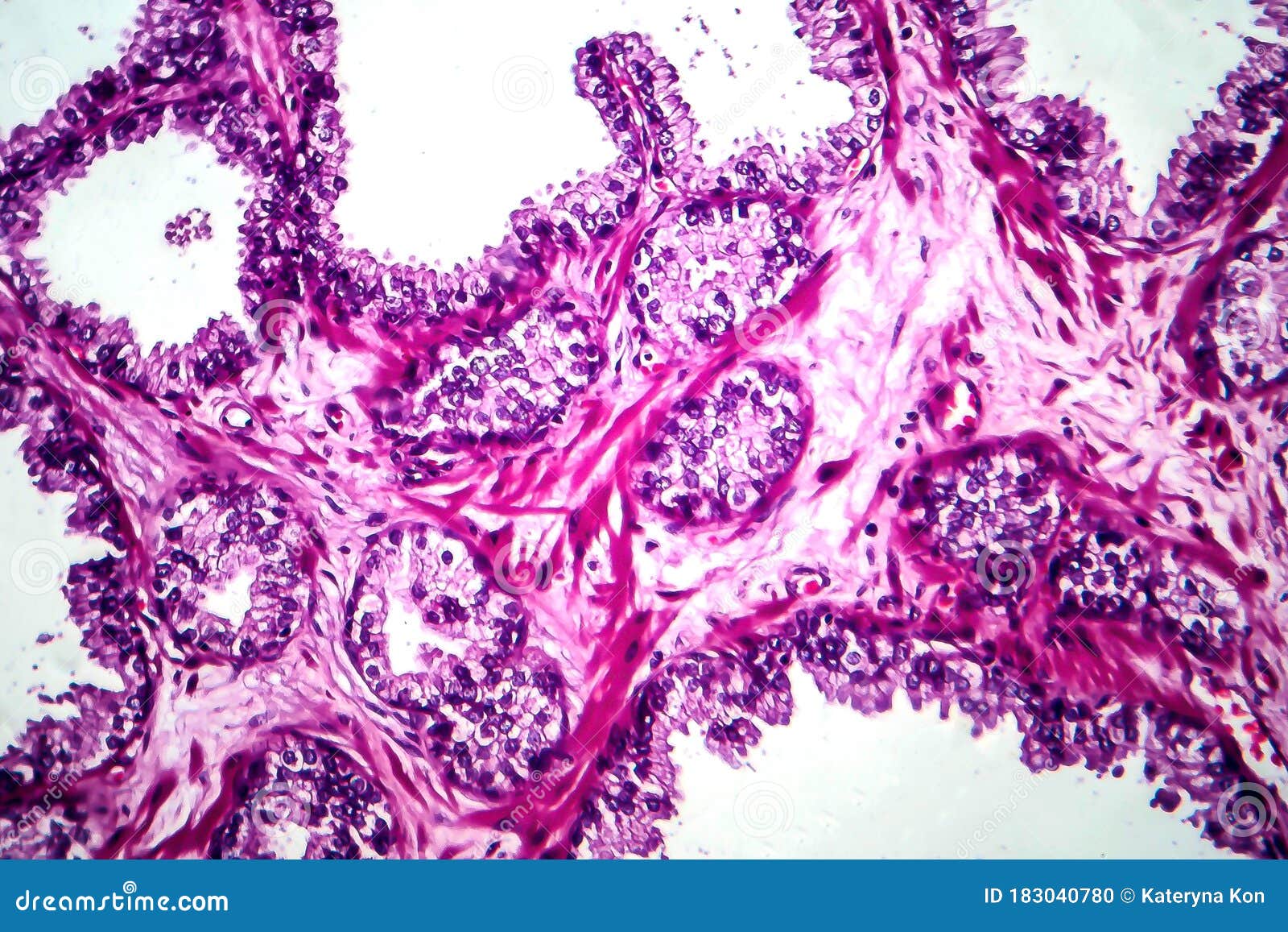 Prostate Cancer, Light Micrograph Stock Photo - Image of oncology ...